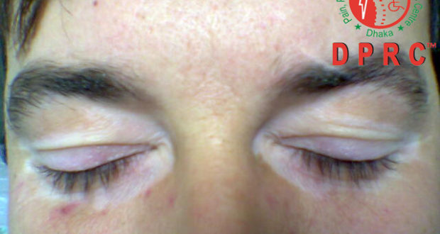 Dealing with Facial discoloration